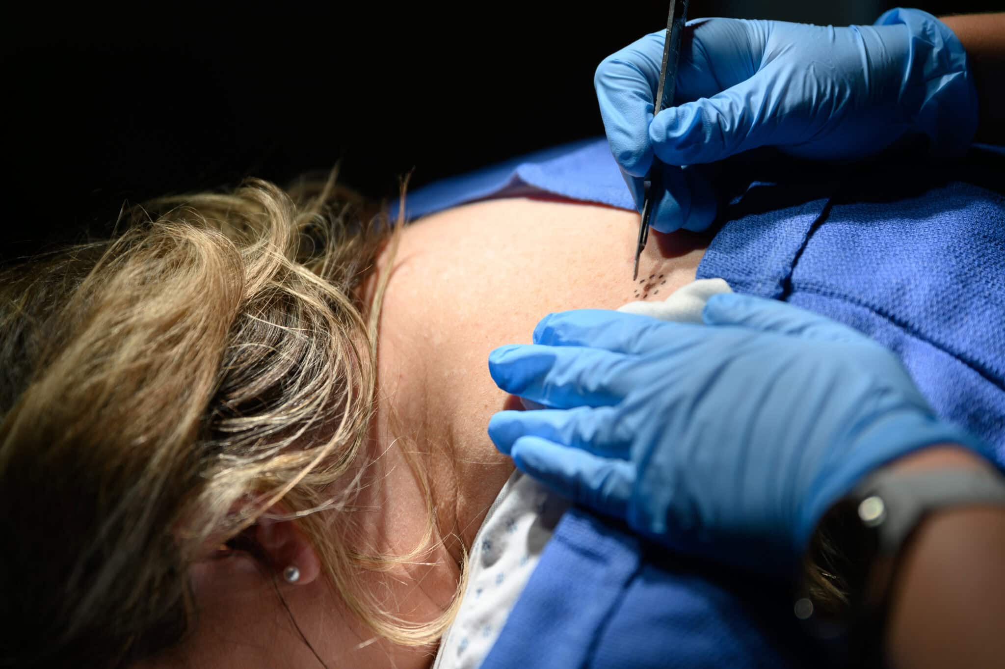 Mohs Surgery | True Dermatology